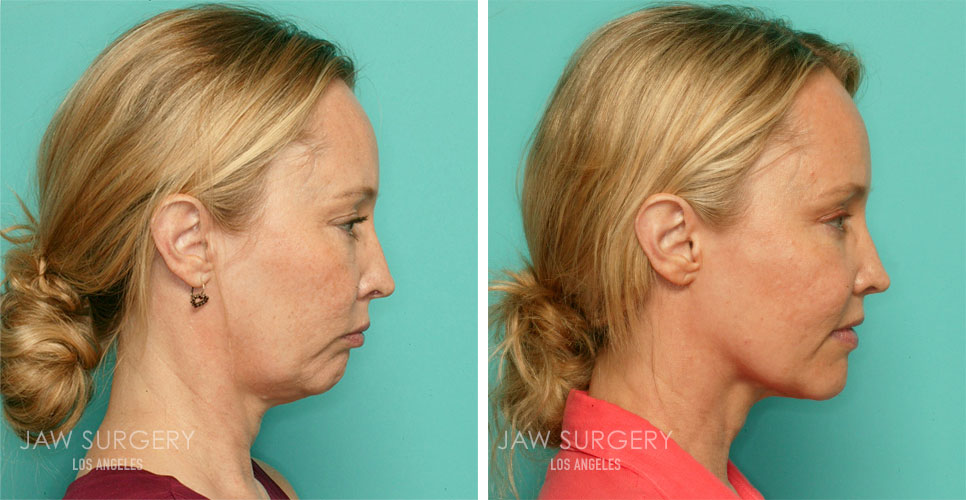 Lips Smaller After Jaw Surgery | Lipstutorial.org Lips Smaller After Jaw Surgery | Lipstutorial.org